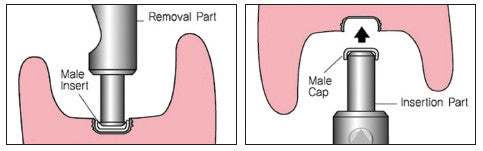 Kerator Magic Tool | Neo Implants - NEO IMPLANTS