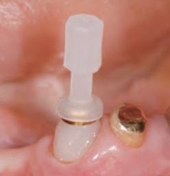 Kerator Locator Abutment System | Neo Implants - NEO IMPLANTS
